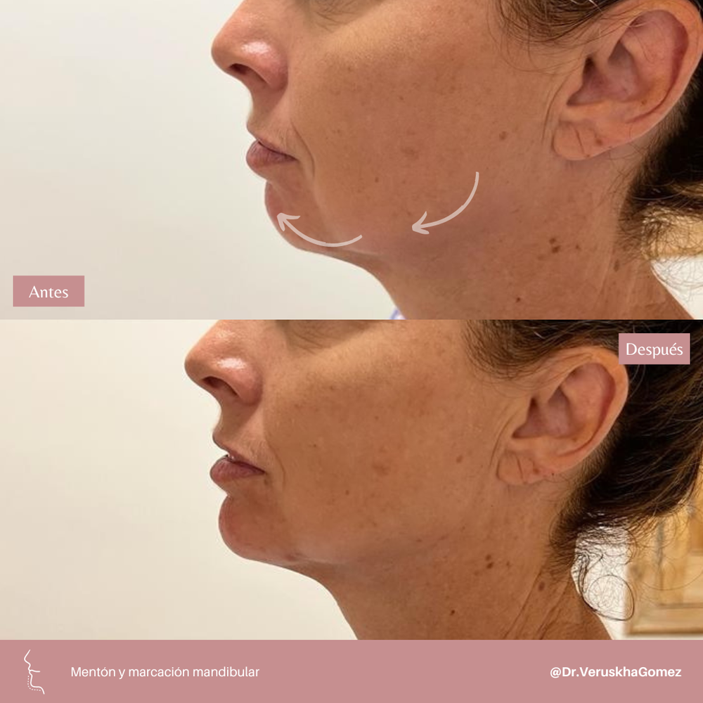 Marcación Mandibular en Valencia | Contorno Facial Natural y ...