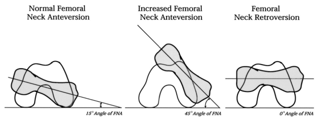 Femoral Version Abnormalities — Hayden Baker, MD