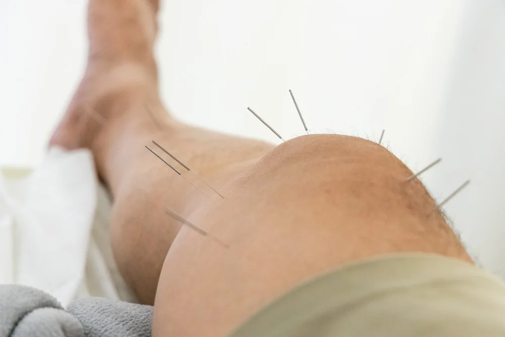 Acupuncture & Chinese Medicine in Riverina, NSW — Wagga Acupuncture Centre