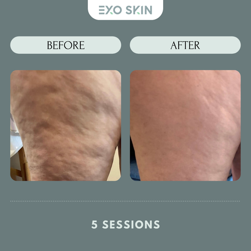 ExoSkin