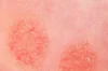Kulit Gatal, Ruam, dan Merah? Kenali Macam Dermatitis yang Perlu ...