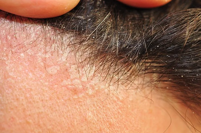 Kulit Gatal, Ruam, dan Merah? Kenali Macam Dermatitis yang Perlu ...