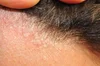 Kulit Gatal, Ruam, dan Merah? Kenali Macam Dermatitis yang Perlu ...