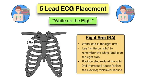 How to Place a 5 Lead ECG: Acronym, Mnemonic, Diagram for Electrode ...