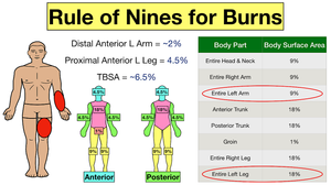 Rule of Nines for Burns: Child and Adult Chart, Calculator, Definition ...