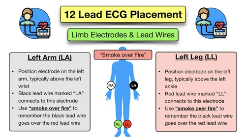 12 Lead ECG Placement: Diagram and Mnemonic for Limb and Precordial ...