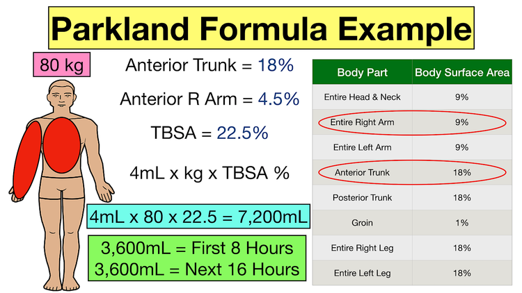Parkland Formula for Burns: Pediatric and Adult Examples, Calculator ...