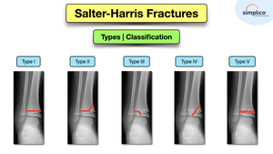 Salter-Harris Fracture Types | Classification System Mnemonic ...