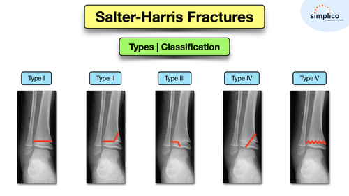 Salter-Harris Fracture Types | Classification System Mnemonic ...