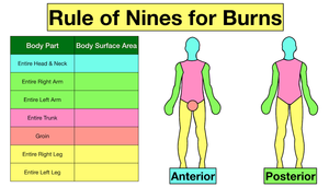 Rule of Nines for Burns: Child and Adult Chart, Calculator, Definition ...