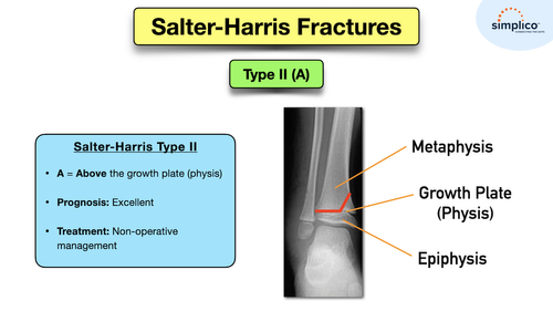 Salter-Harris Fracture Types | Classification System Mnemonic ...