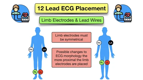 12 Lead ECG Placement: Diagram and Mnemonic for Limb and Precordial ...
