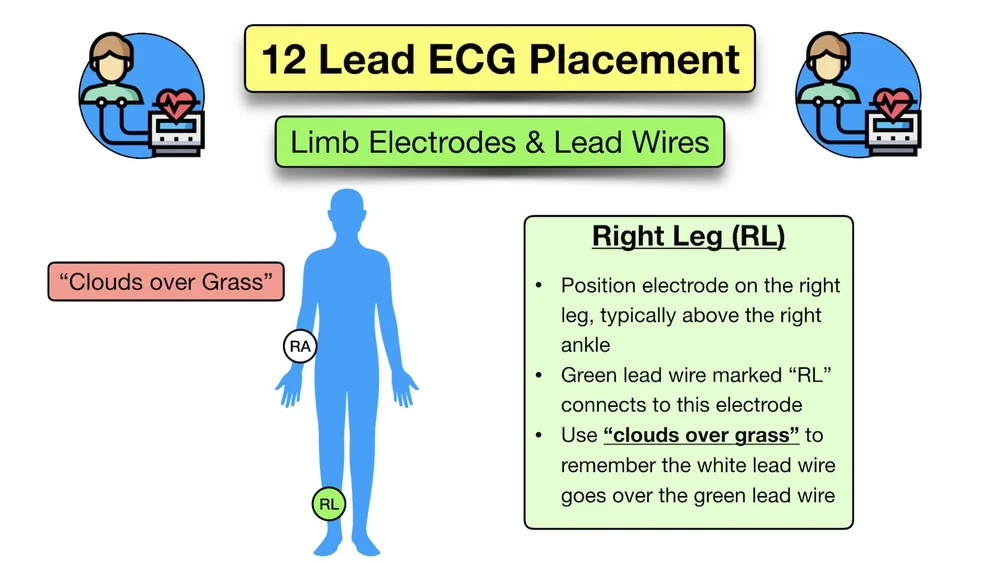 12 Lead ECG Placement: Diagram and Mnemonic for Limb and Precordial ...