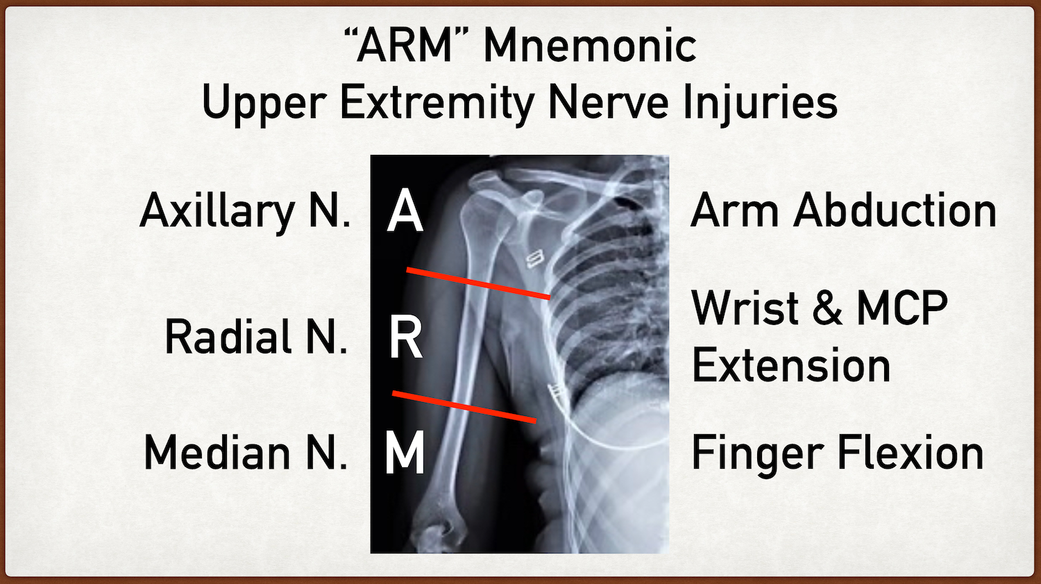Upper Extremity Nerve Mnemonic: Anatomy, Distribution, Injuries, and ...