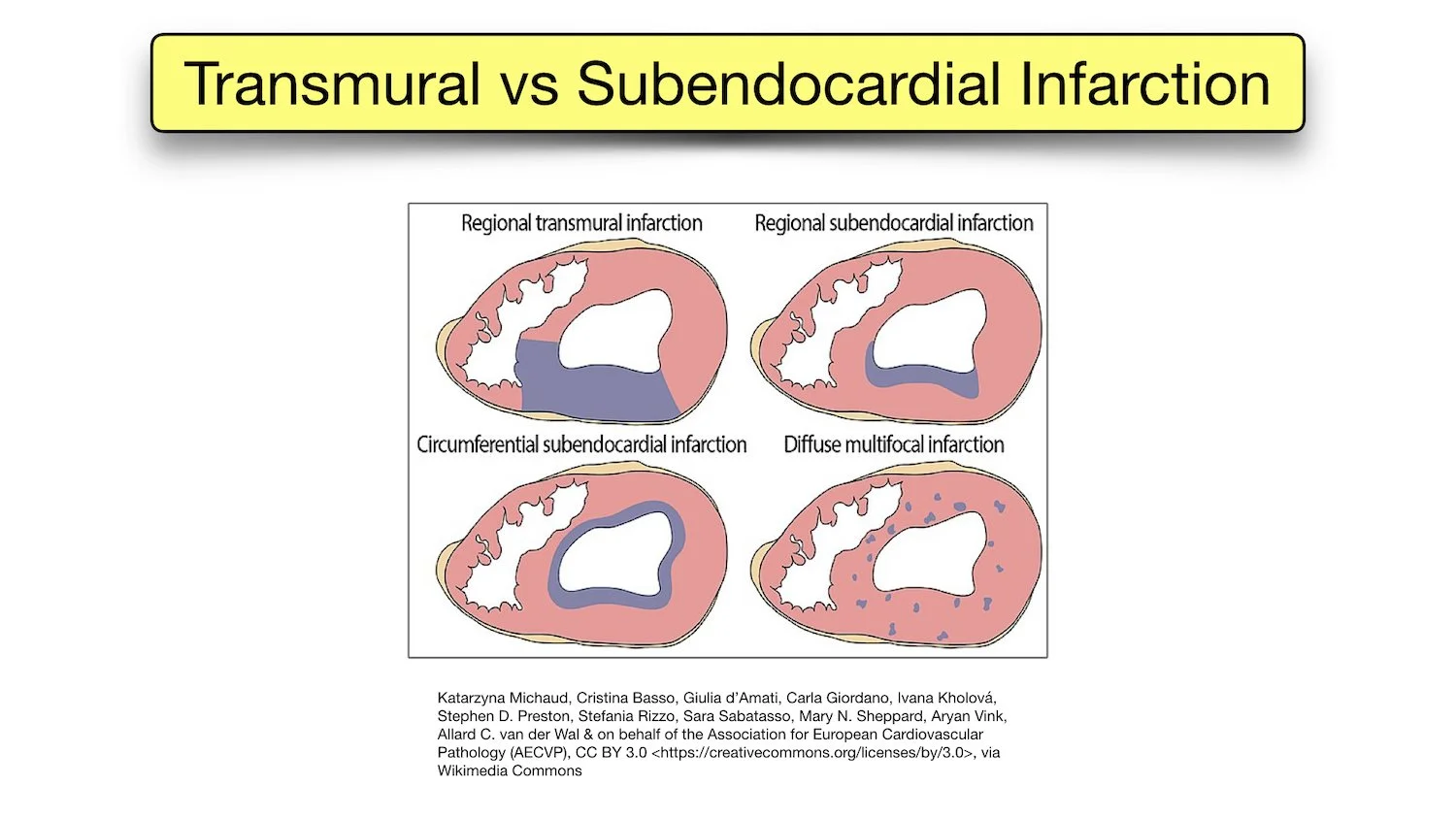 ICD-10-CM Medical Code Lookup: Ischemic Heart Disease, Heart Attack ...