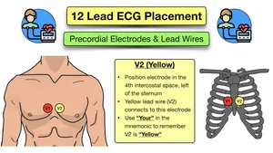 12 Lead ECG Placement: Diagram and Mnemonic for Limb and Precordial ...