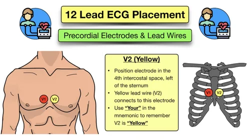 12 Lead ECG Placement: Diagram and Mnemonic for Limb and Precordial ...
