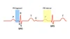 ECG Waveform Explained: EKG Labeled Diagrams and Components — Simplico