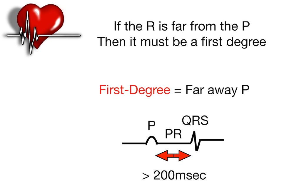 AV Heart Block Poem: First, Second, Third Degree Types, ECG Rhythm ...