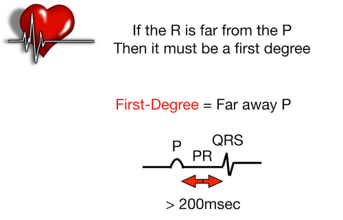 AV Heart Block Poem: First, Second, Third Degree Types, ECG Rhythm ...