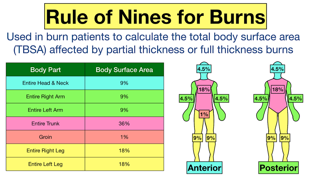 Parkland Formula for Burns: Pediatric and Adult Examples, Calculator ...