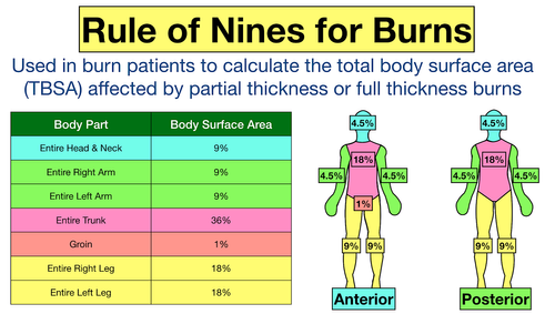 Parkland Formula for Burns: Pediatric and Adult Examples, Calculator ...