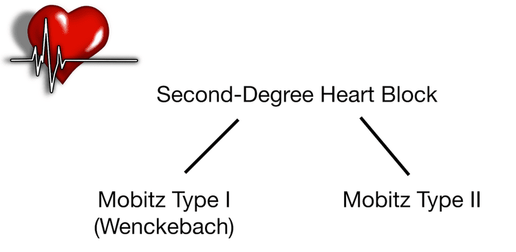 AV Heart Block Poem: First, Second, Third Degree Types, ECG Rhythm ...
