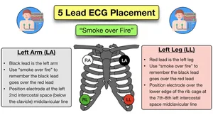 How to Place a 5 Lead ECG: Acronym, Mnemonic, Diagram for Electrode ...