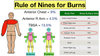 Rule of Nines for Burns: Child and Adult Chart, Calculator, Definition ...