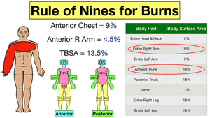 Rule of Nines for Burns: Child and Adult Chart, Calculator, Definition ...