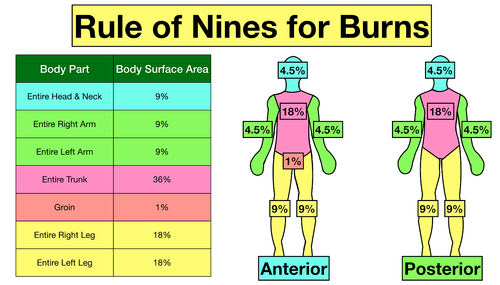 Rule of Nines for Burns: Child and Adult Chart, Calculator, Definition ...