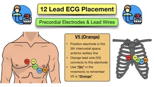 12 Lead ECG Placement: Diagram and Mnemonic for Limb and Precordial ...