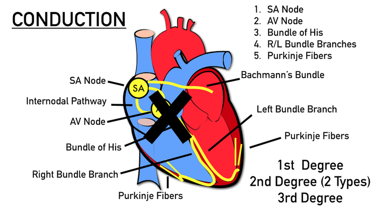 AV Heart Block Poem: First, Second, Third Degree Types, ECG Rhythm ...