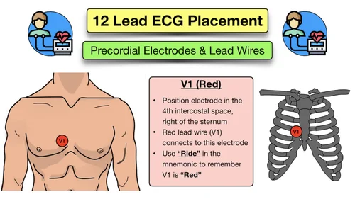 12 Lead ECG Placement: Diagram and Mnemonic for Limb and Precordial ...