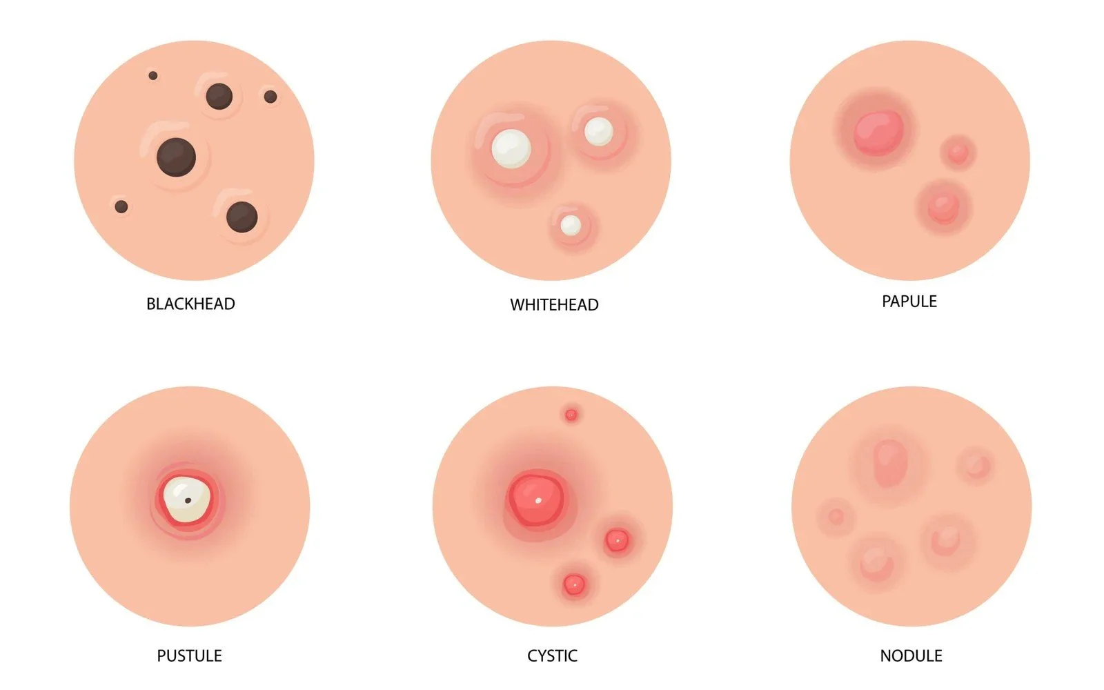 Acne Affects More Than Teens: — Cardinal Dermatology