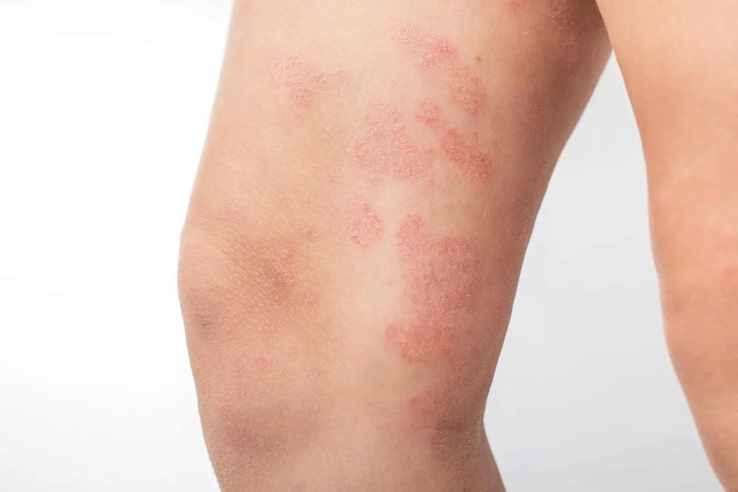 Eczema — Cardinal Dermatology