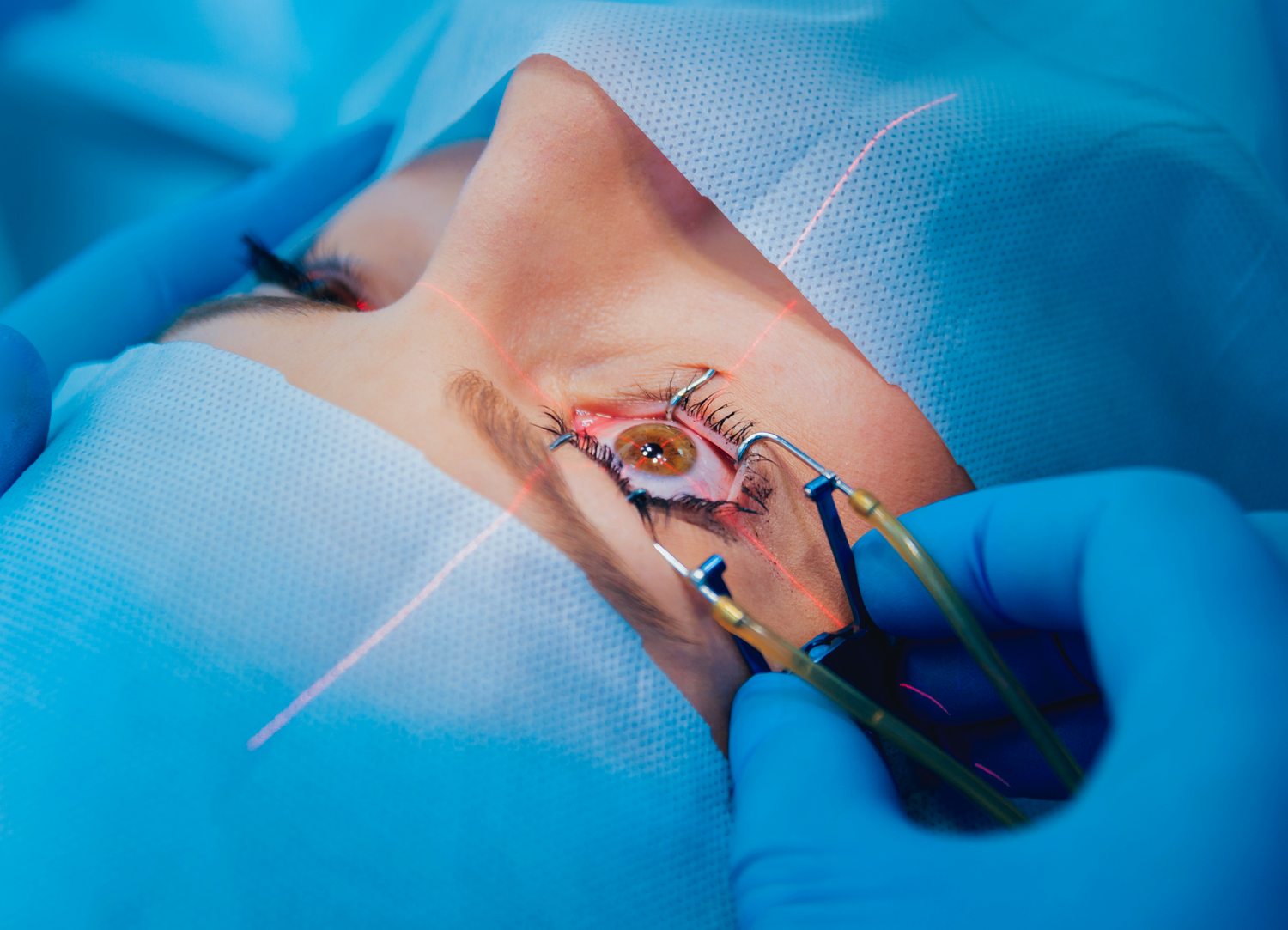 How Cataract Surgery Works | Effectiveness Explained