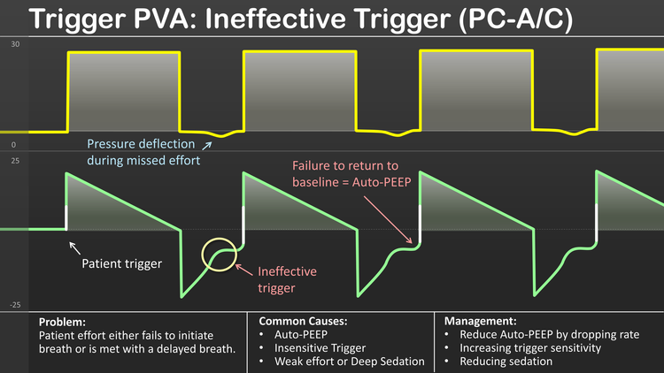 Trigger PVA: Ineffective Trigger — Airway Academy
