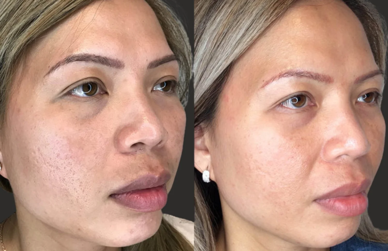 Microneedling: A Collagen-Inducing Treatment for Acne Scars — FAM ...