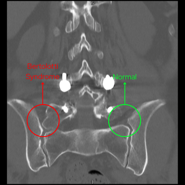 Bertolotti Syndrome | Causes, Symptoms & Surgery — Mr Gordan Grahovac