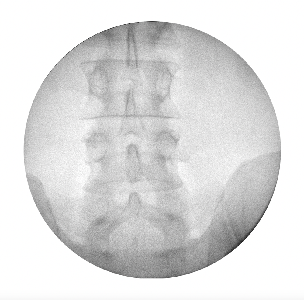 Epidural Steroid Injections for Lower Back Pain in Franklin & Nashville ...