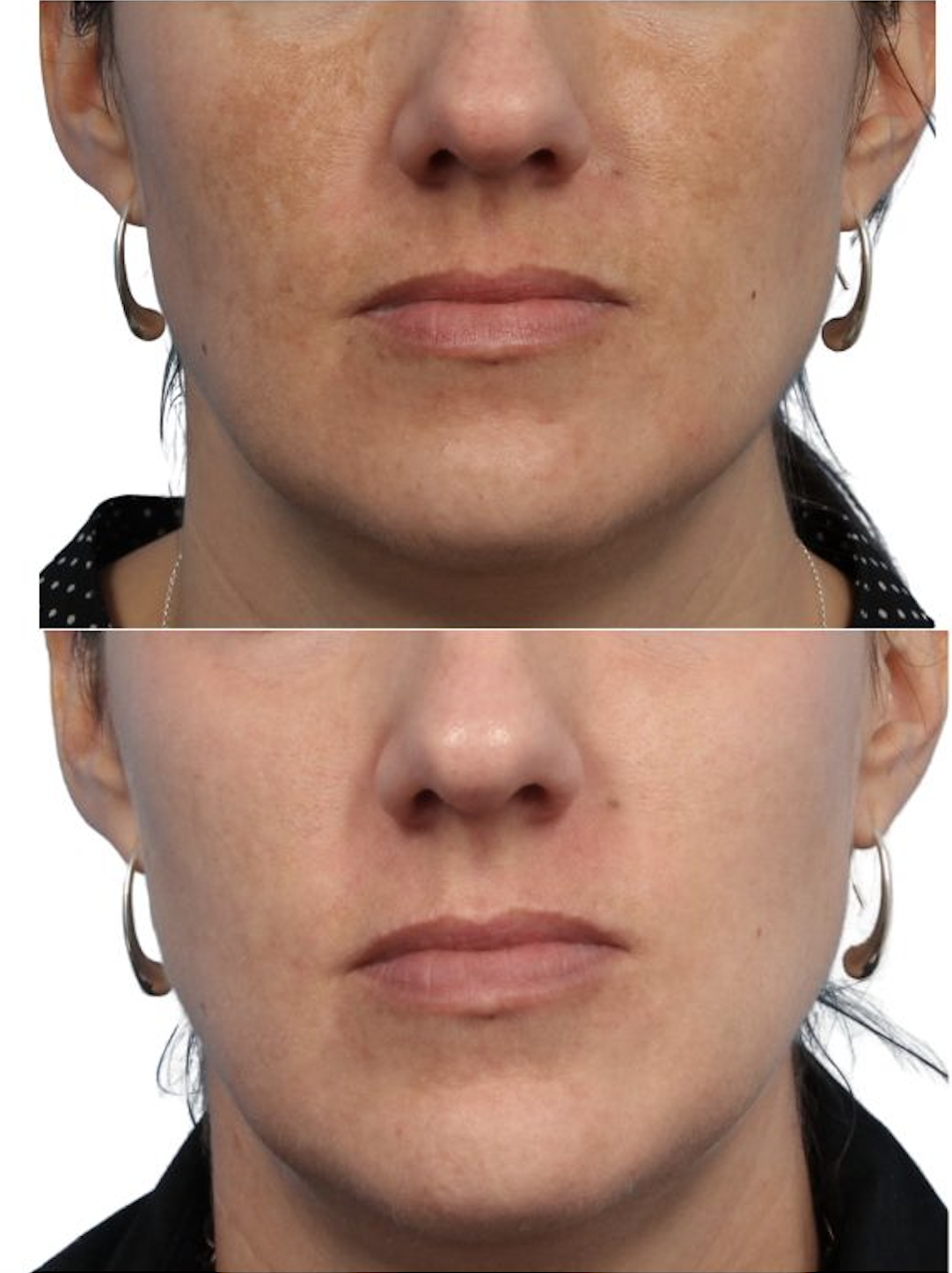 Melasma | Treat Melasma Effectively Today — Brisbane West Dermatology
