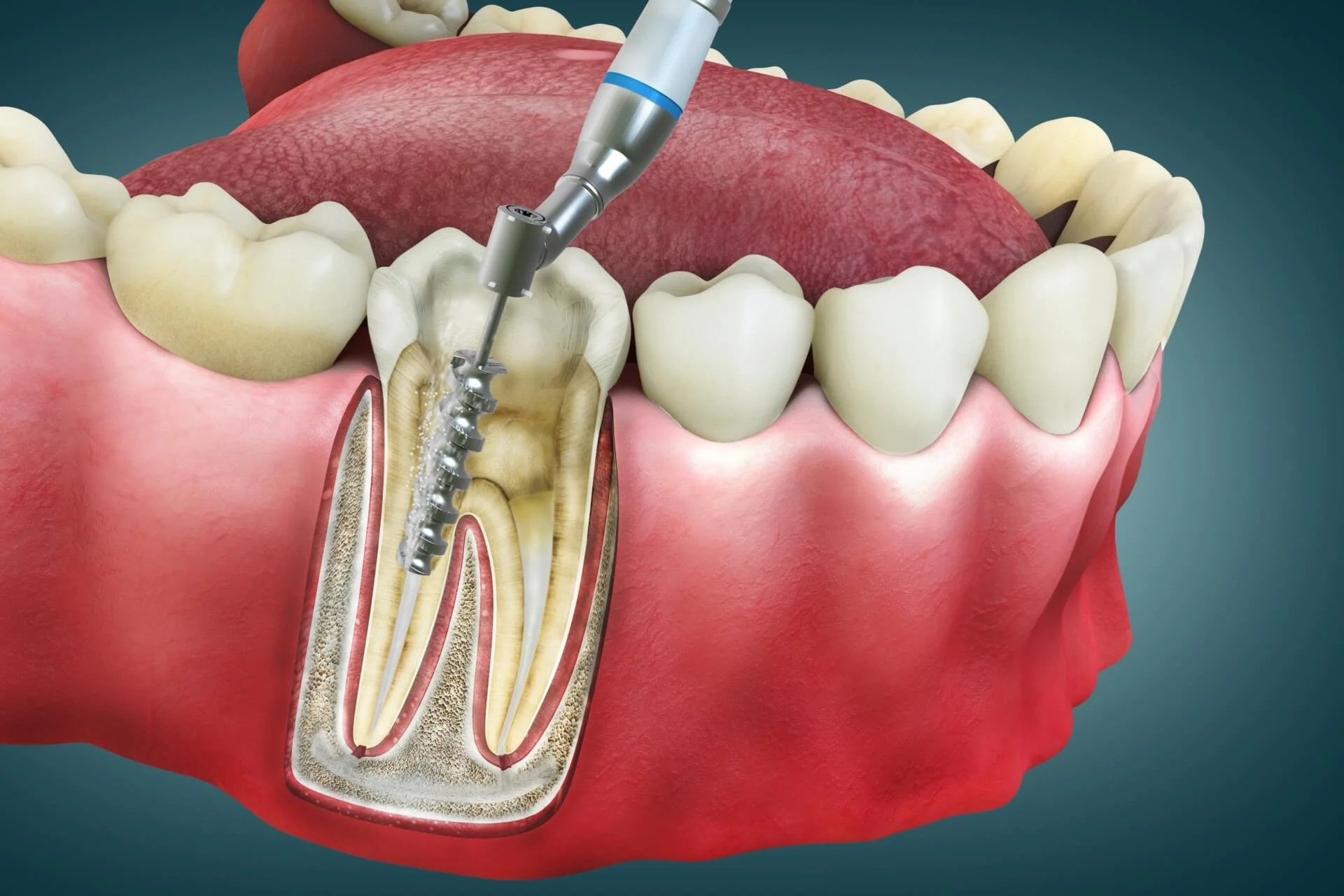 Preferred Root Canal Service - Post Falls, ID | BestDentist