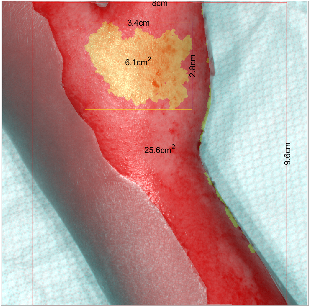 Burn Solutions — Perfusio