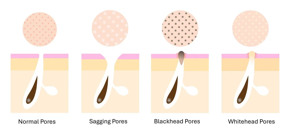 Are Large Pores Genetic? What You Can (and Can’t) Actually Change — The ...
