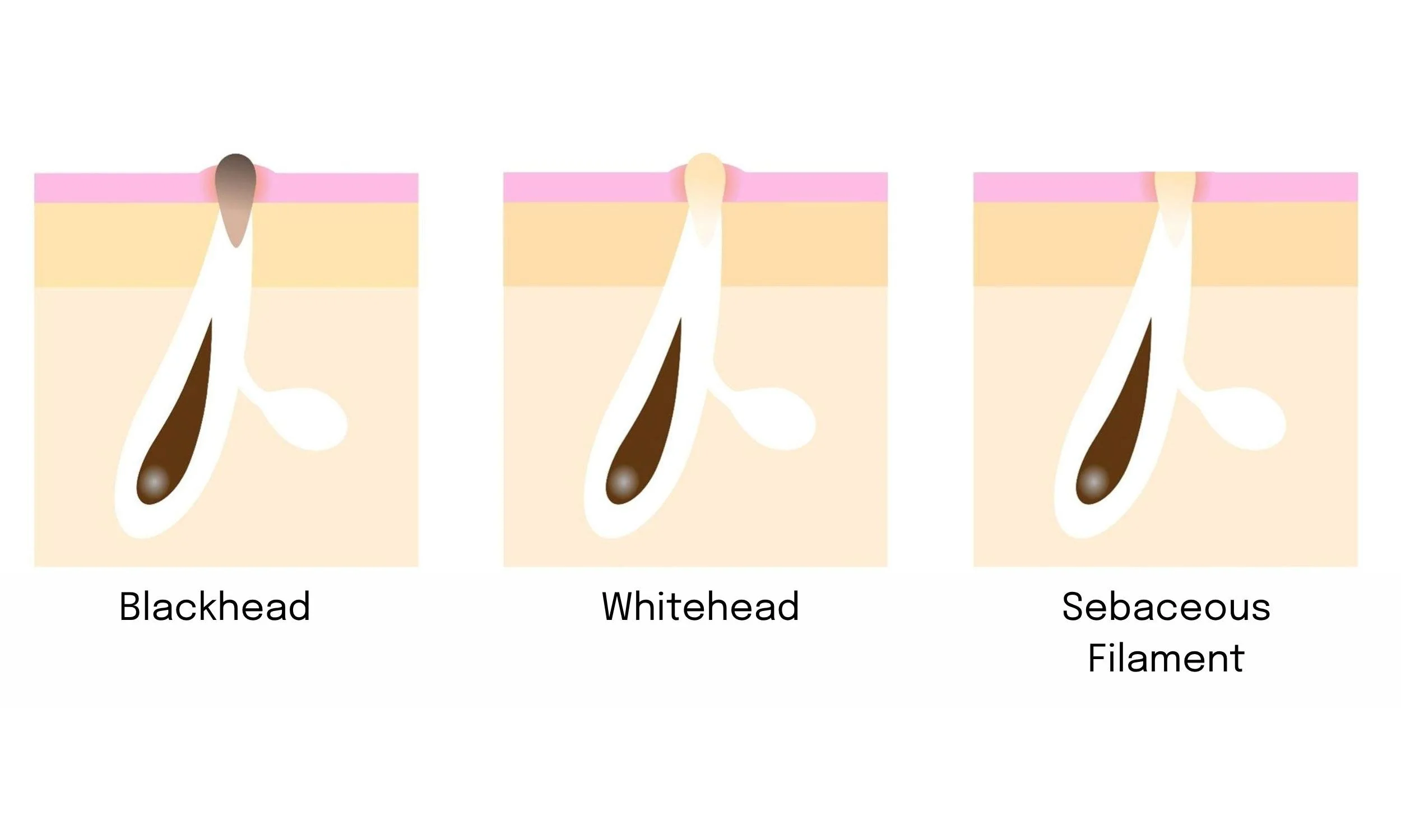 The Real Reason You Still Have Blackheads (Even With Actives) — The Beauty Lab