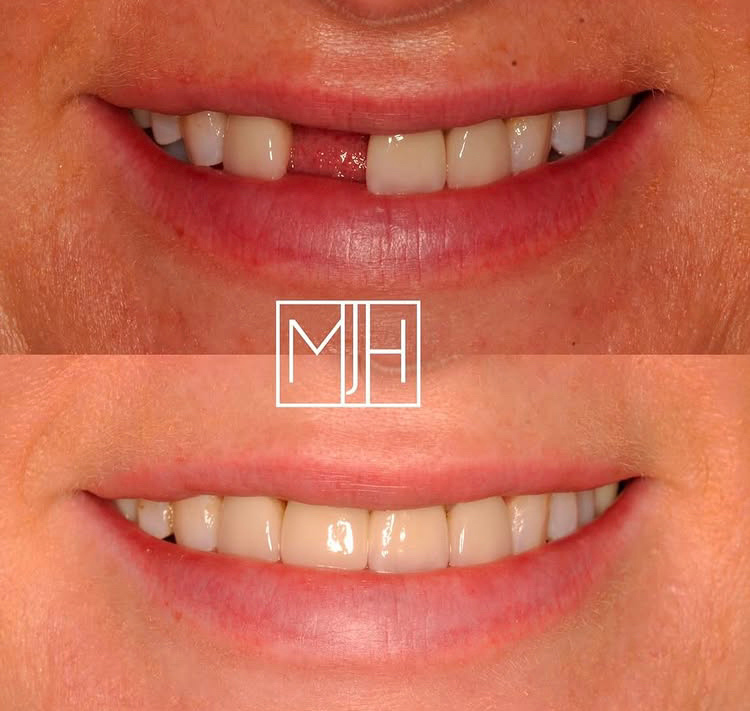 Dental Implants | Restore Your Smile — Horizon Dental