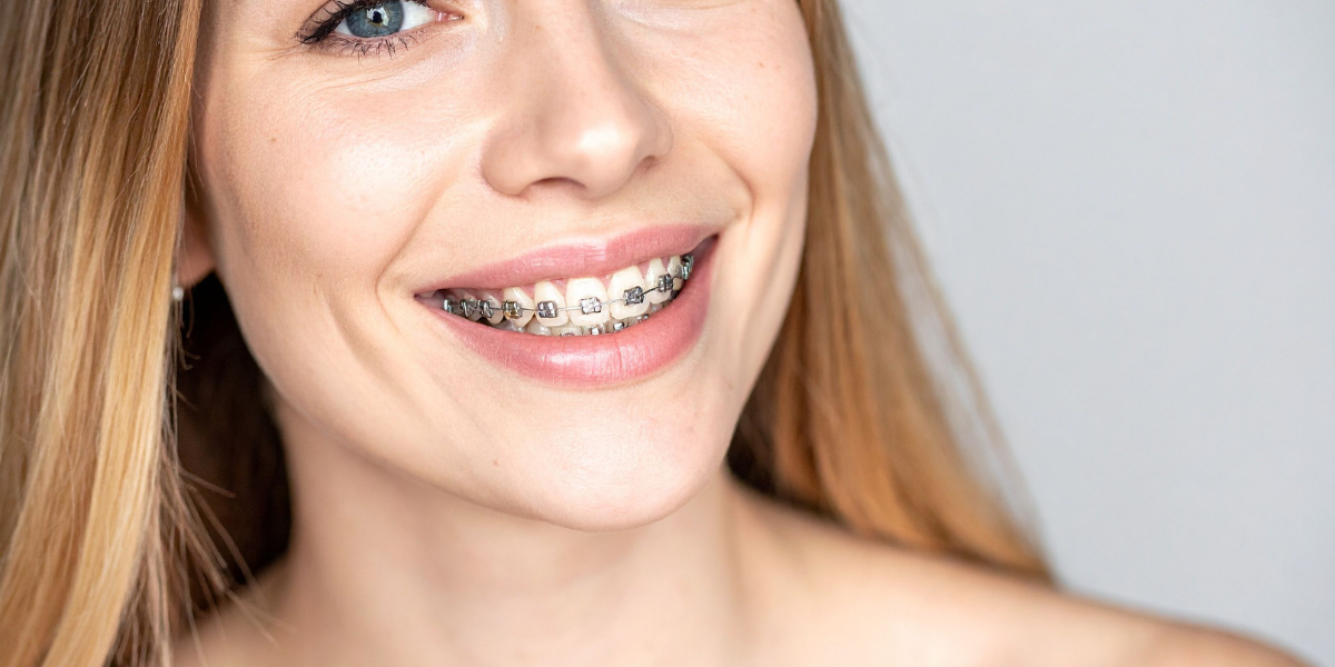 How Long Do Braces Take? Realistic Treatment Timeline | Paramus ...