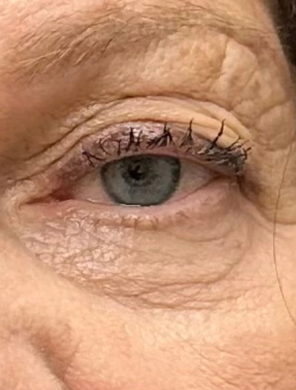 Ptosis Correction | Restore Vision Today — Rand Rodgers MD