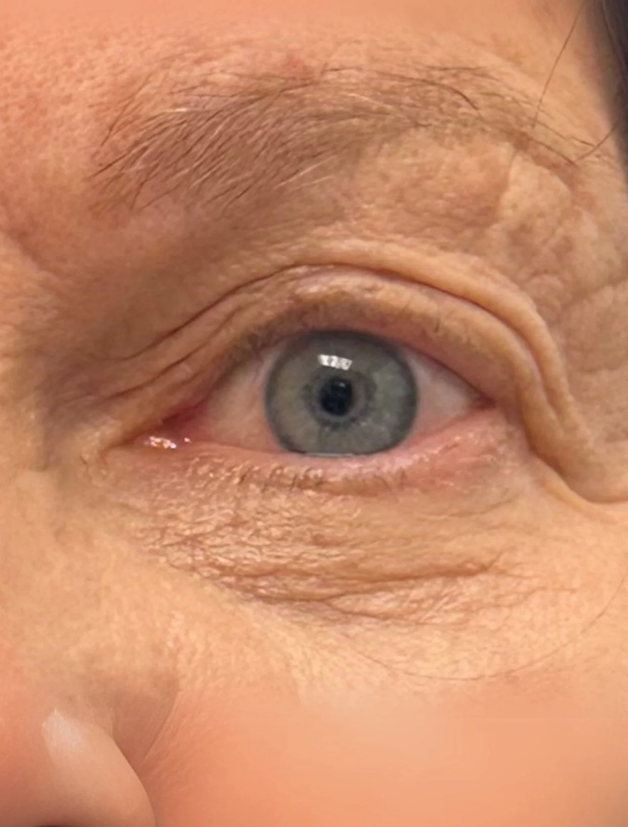 Ptosis Correction | Restore Vision Today — Rand Rodgers MD